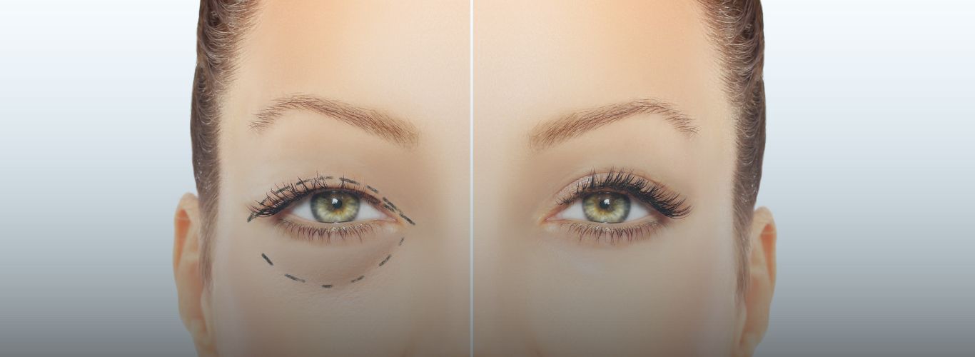 Expert Oculoplasty & Eyelid Surgery | Burjeel Reem