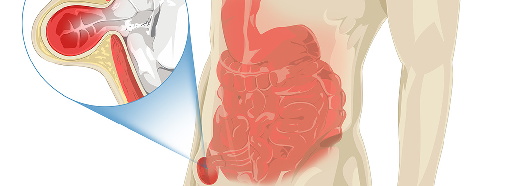 Hernias and Abdominal Wall Surgery - Burjeel Medical City, Abu Dhabi