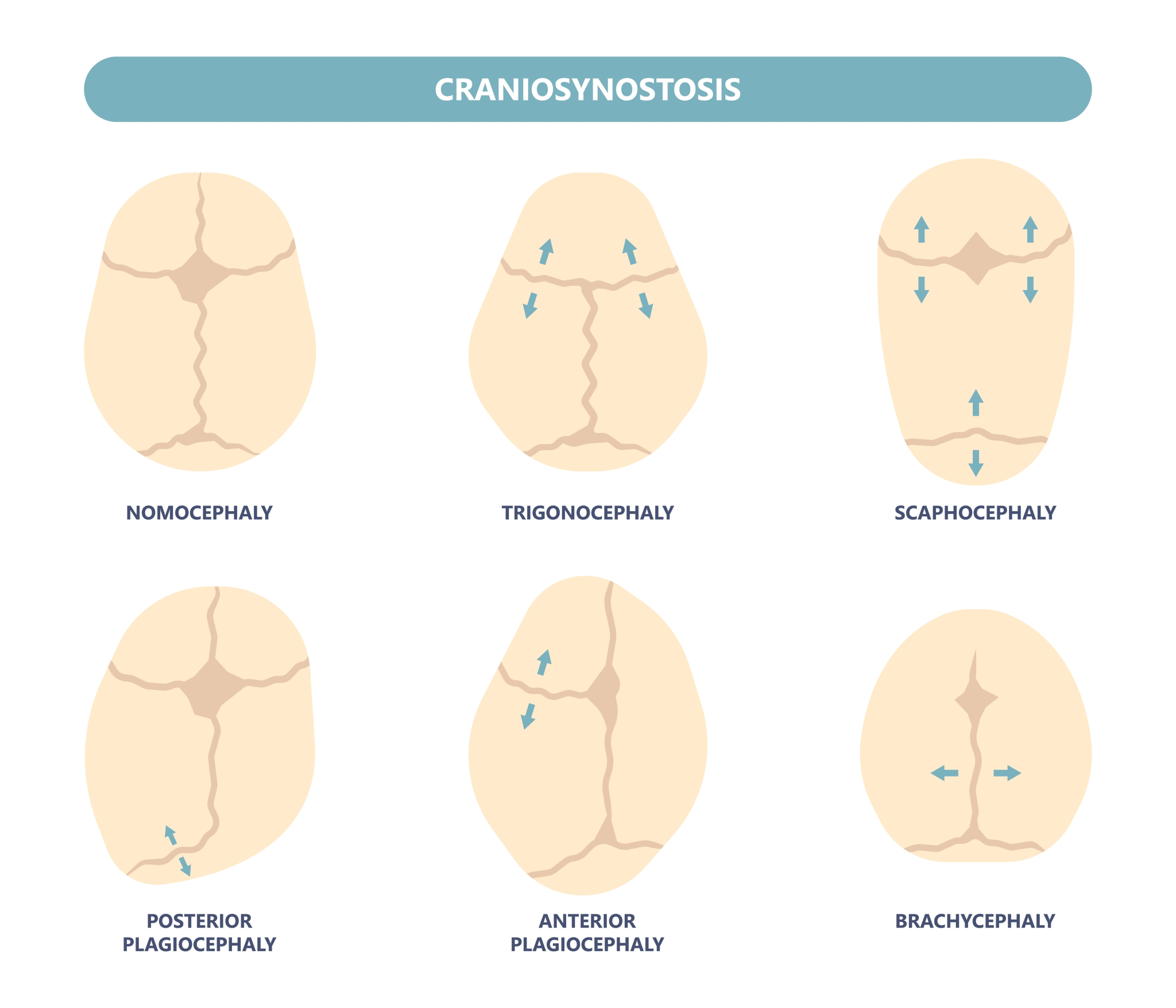 Understanding Craniosynostosis: Types, Symptoms, Treatment
