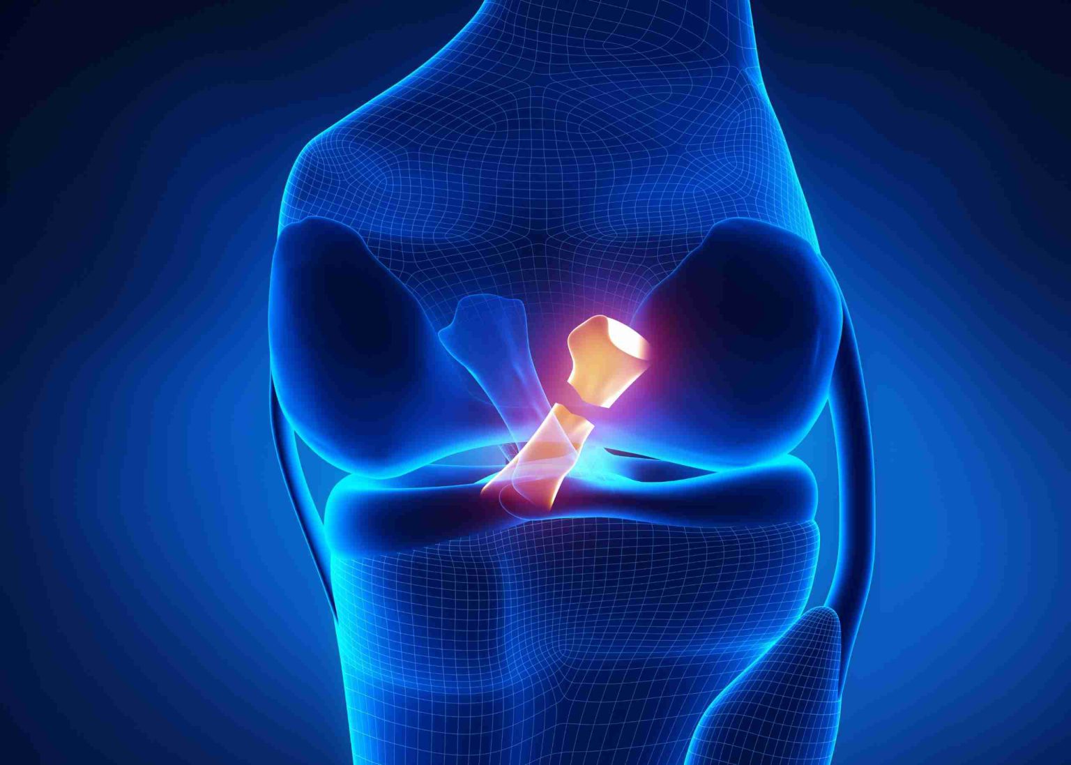 PCL Injury | PCL Surgery | Burjeel Hospital Dubai