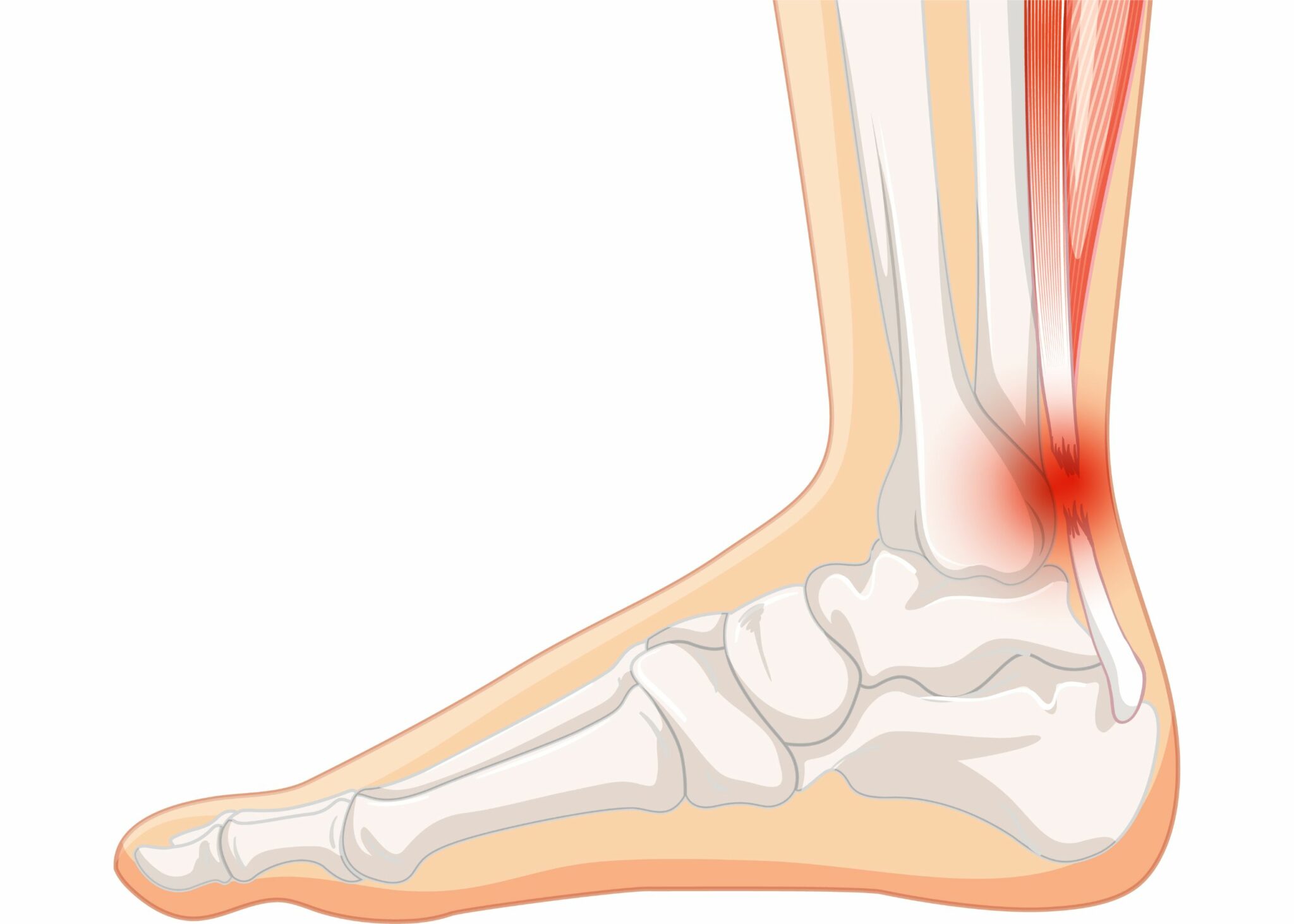 Treatment for Achilles Tears | Dr. Roger Haene | Burjeel Hospital Abu Dhabi