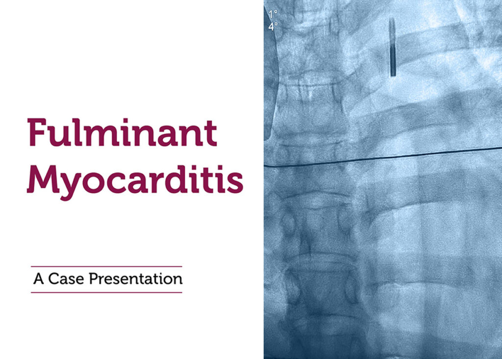 Fulminant Myocarditis: Rapid Diagnosis & Multidisciplinary Care