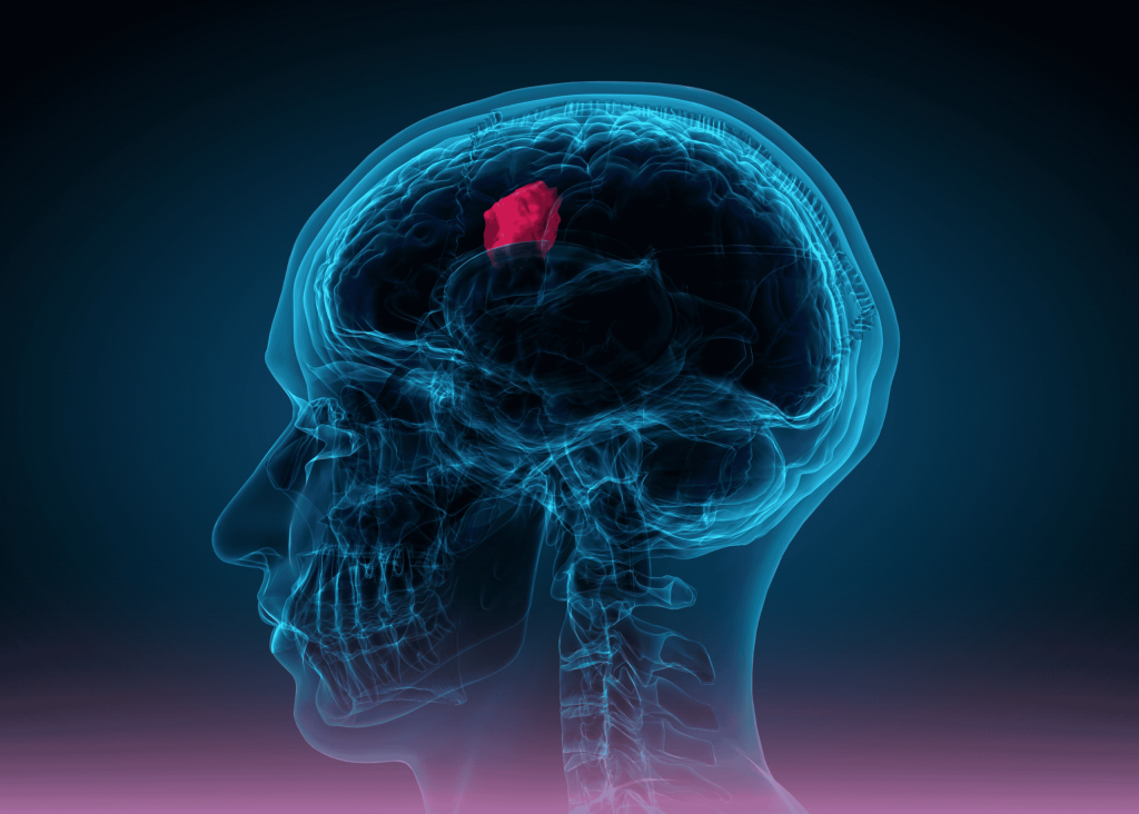 Advanced Neuro Navigation| Complex Brain Tumor Removal