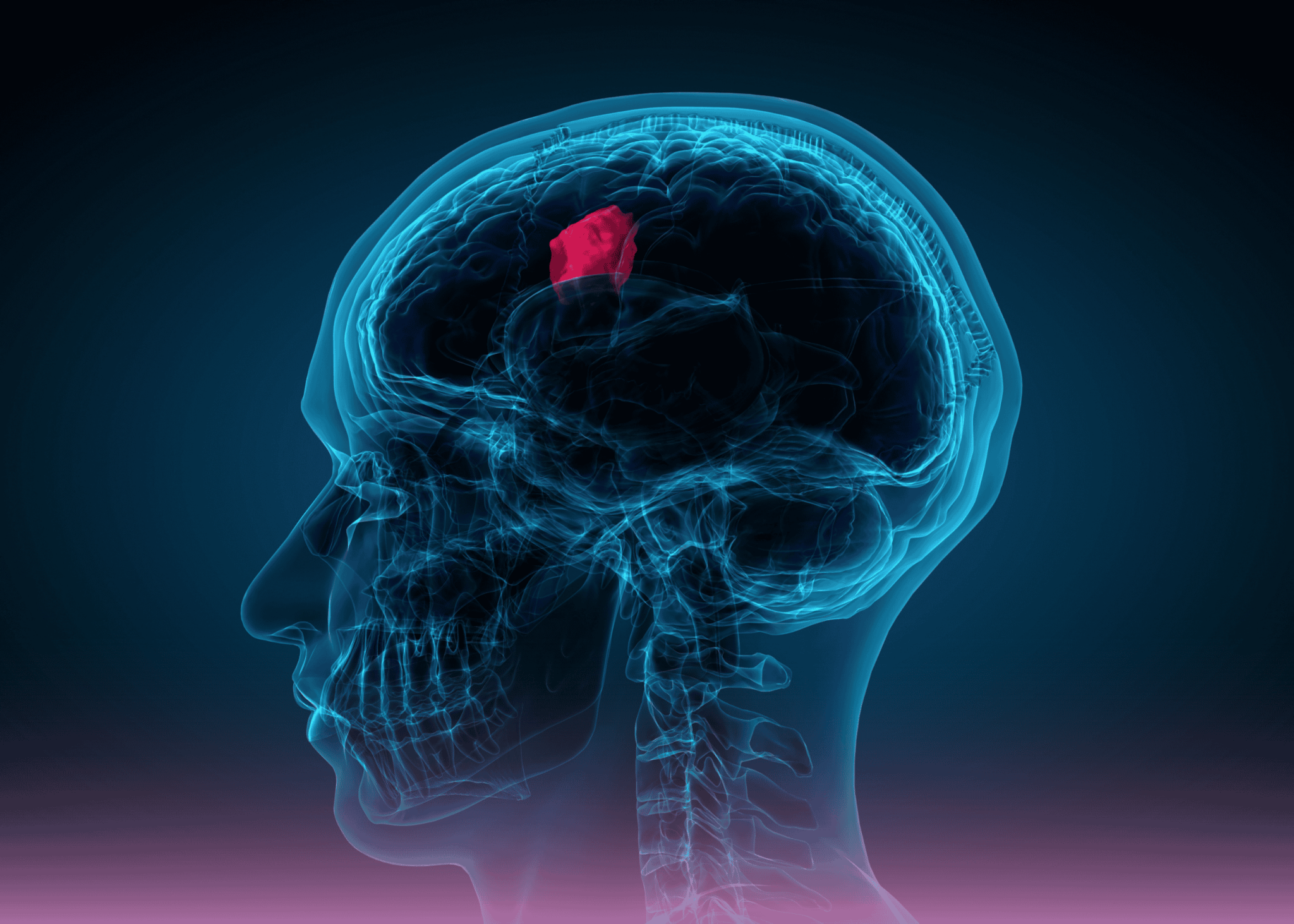 Advanced Neuro Navigation| Complex Brain Tumor Removal