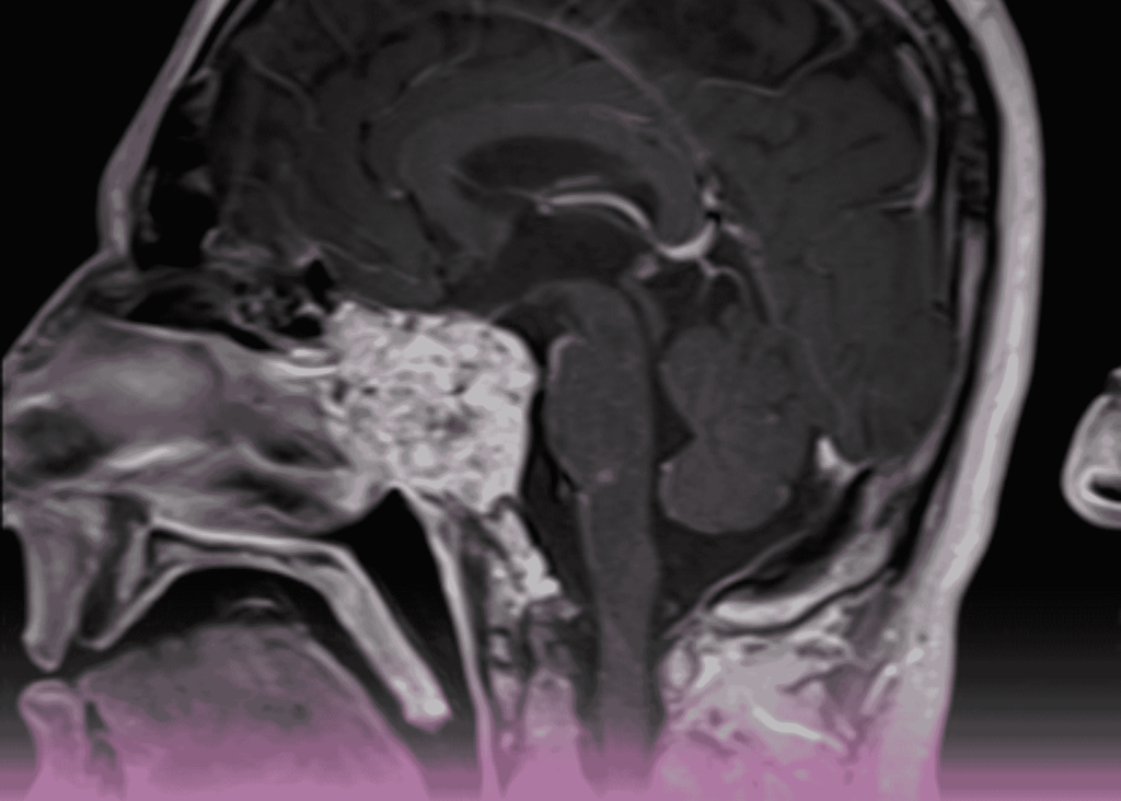 Clival Chordoma: Endoscopic Surgical Management of a Rare Skull Base Tumor