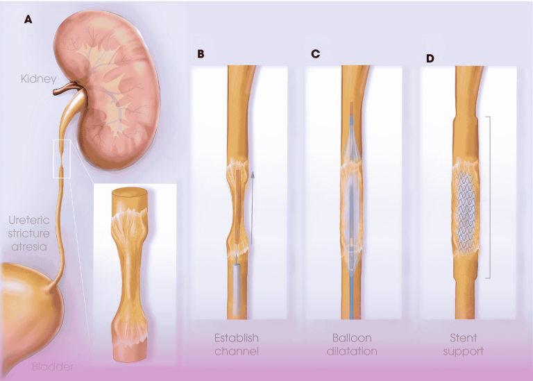 Laparoscopic and Ureteroscopy Management of Recurrent Ureteric Strictures