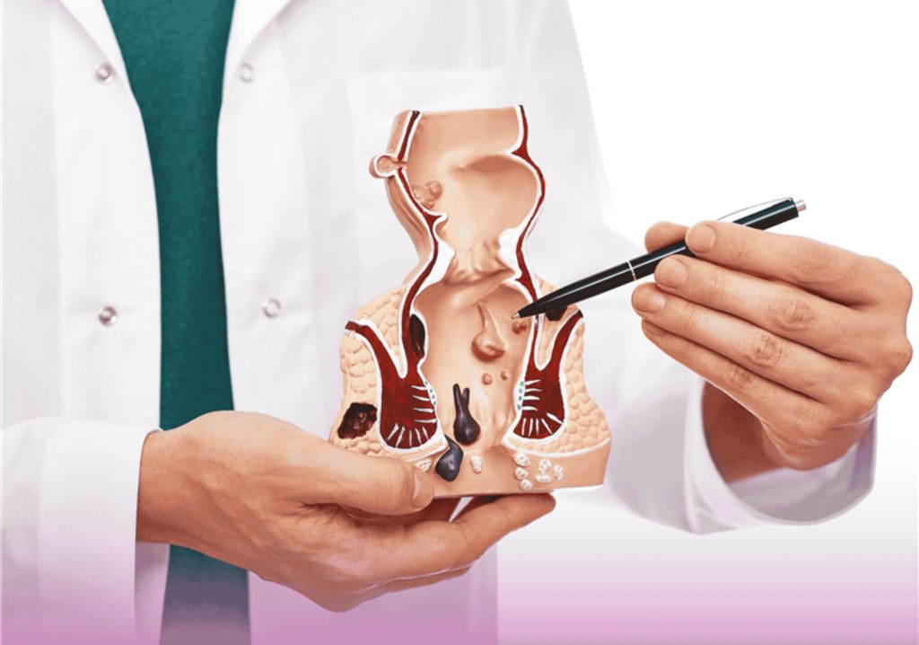 Hemorrhoids Treatment Guide: Symptoms & External Hemorrhoid Relief