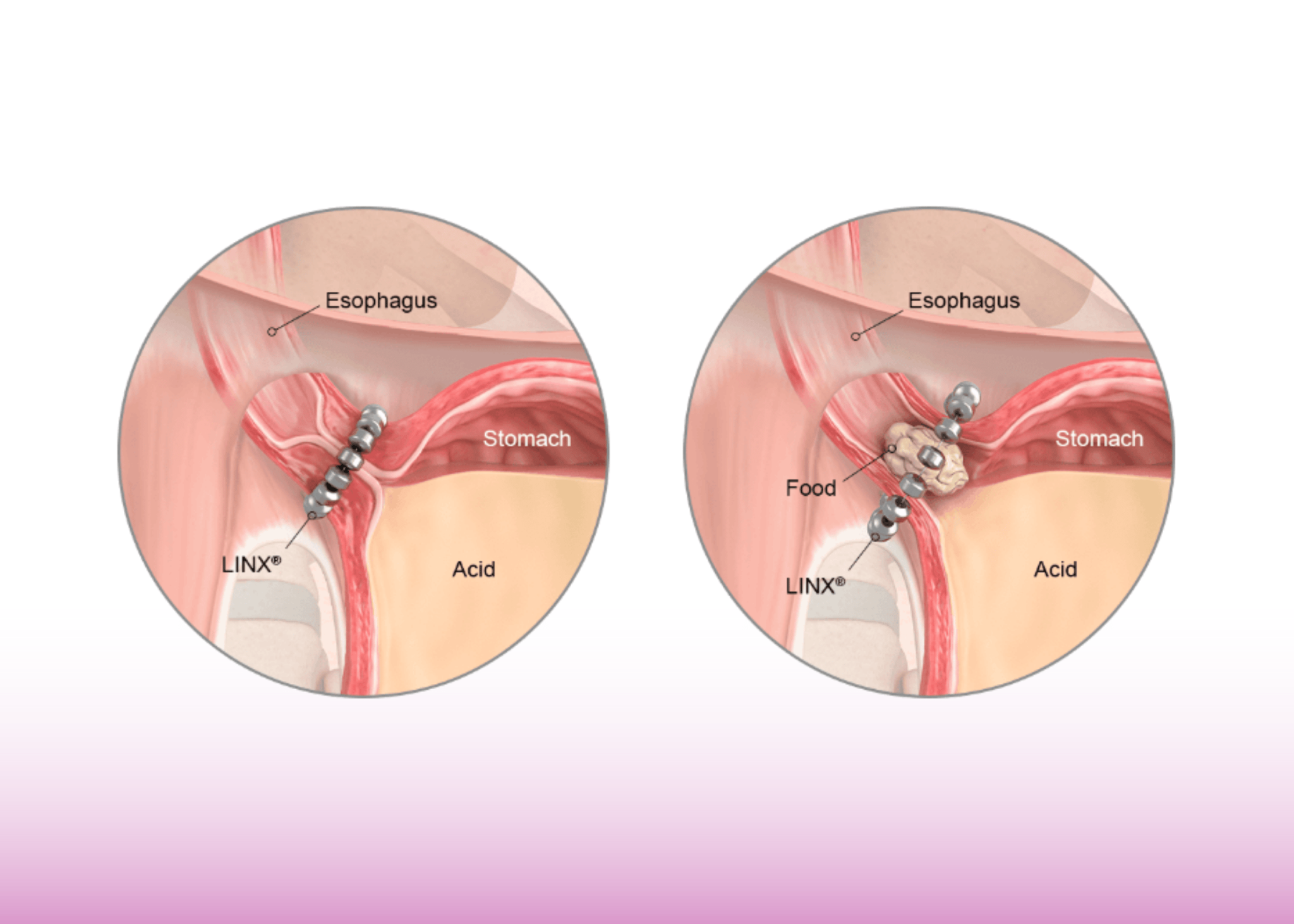 LINX Device Successfully Treats GERD After Bariatric Surgery