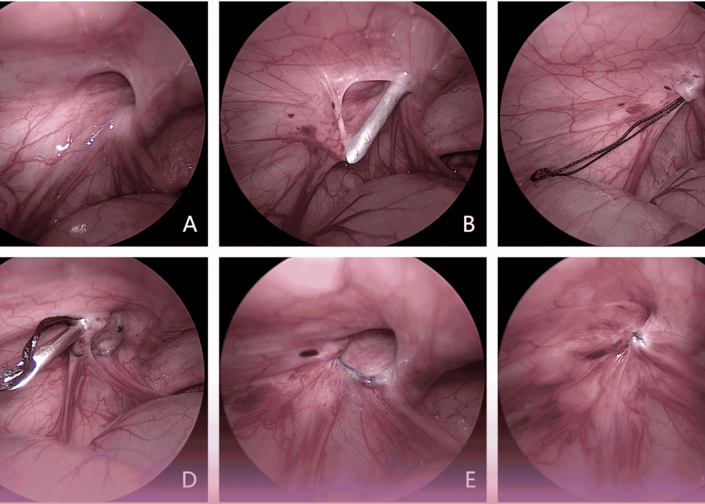 Laparoscopic Inguinal Hernia Repair in Neonates| Burjeel