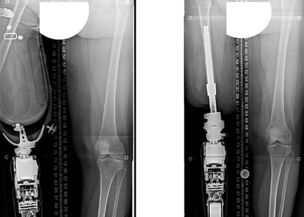 Advanced Osseointegration Surgery for Transtibial Amputee | BMC