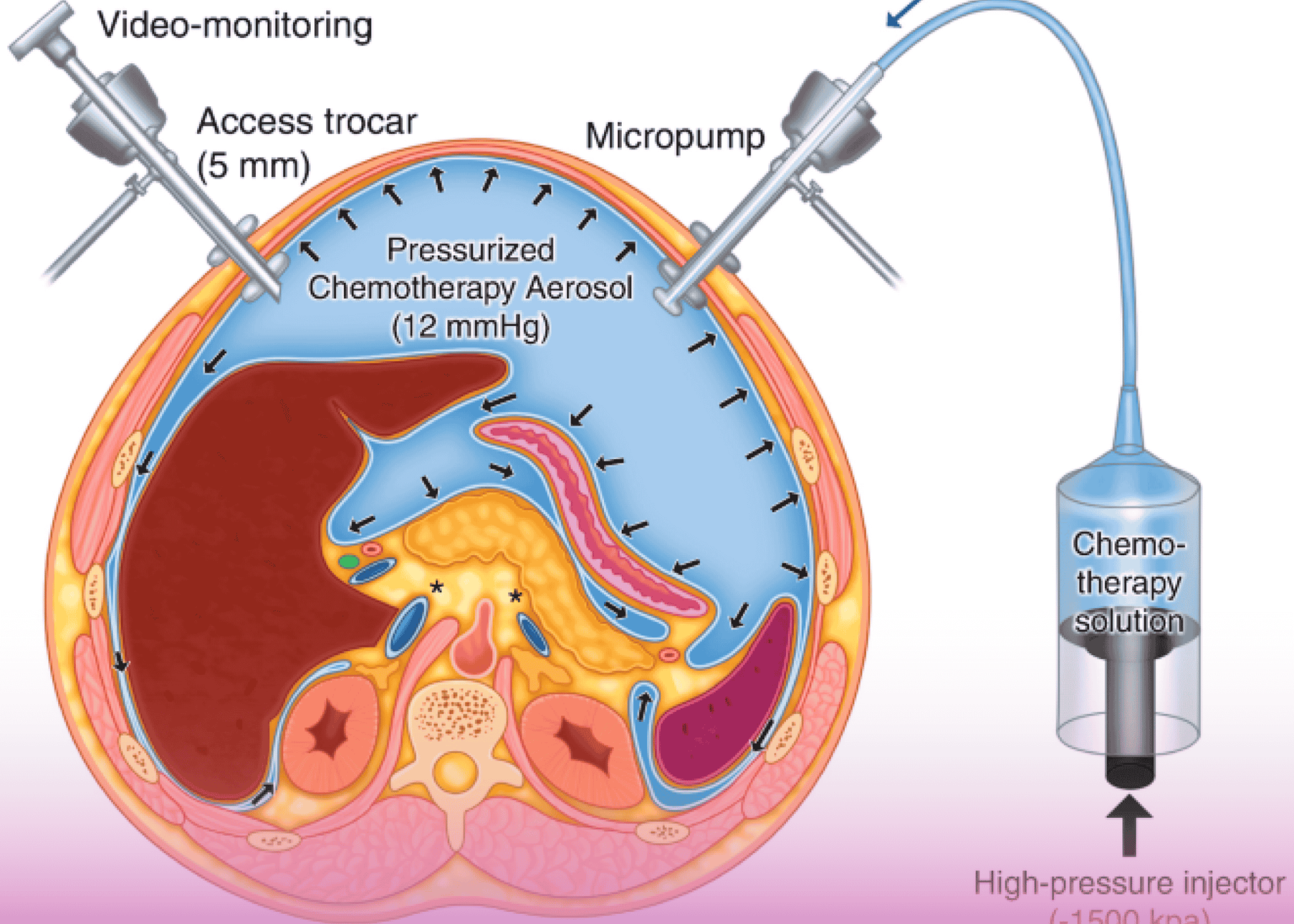 العلاج بتقنية PIPAC: علاج لسرطان الصفاق