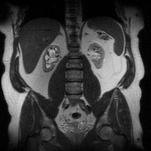 Retrocaval Ureter: Surgical Management of an Ultra-Rare Congenital ...