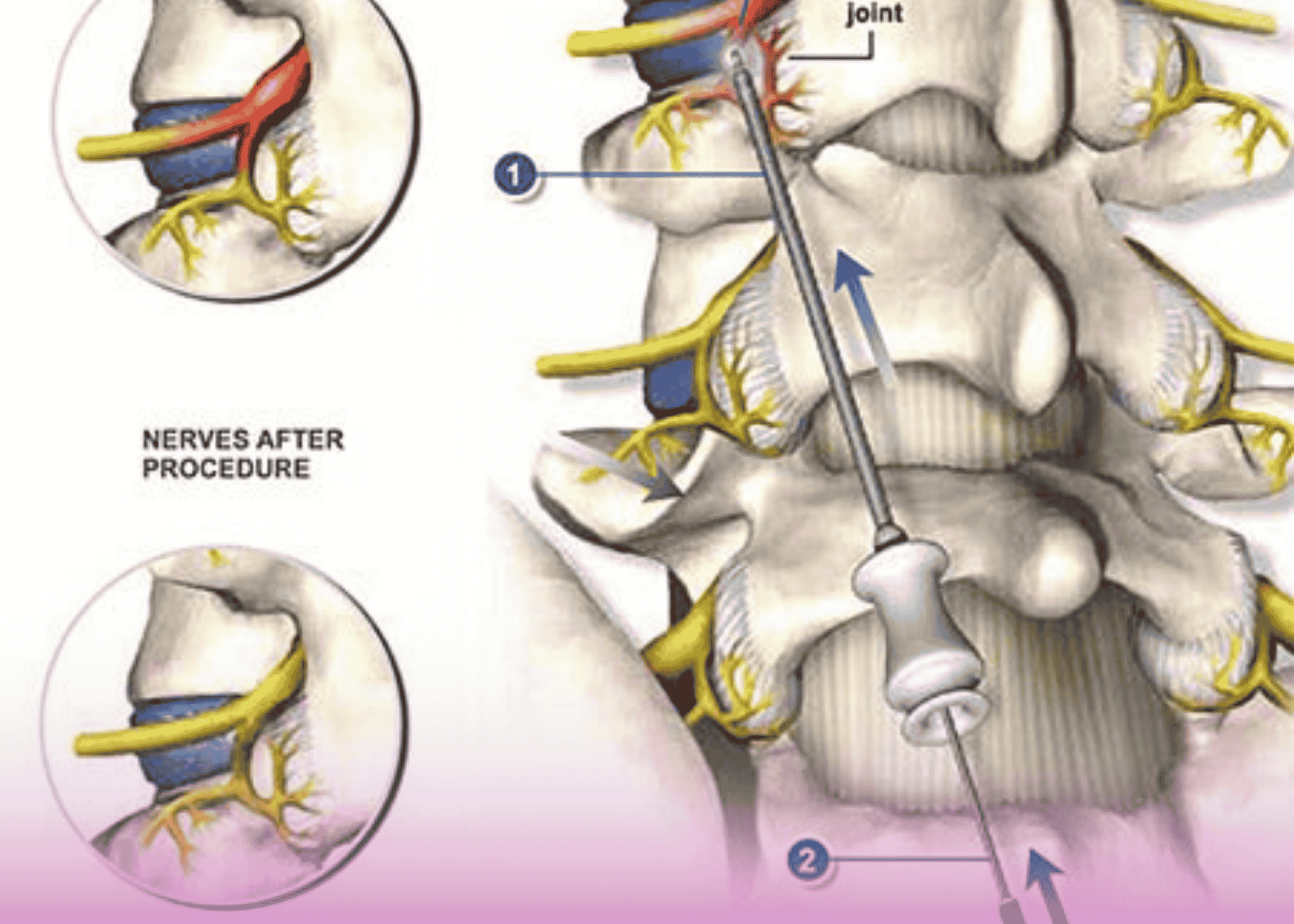 Lumbar Sympathetic Block: A Minimally Invasive Approach to Managing ...